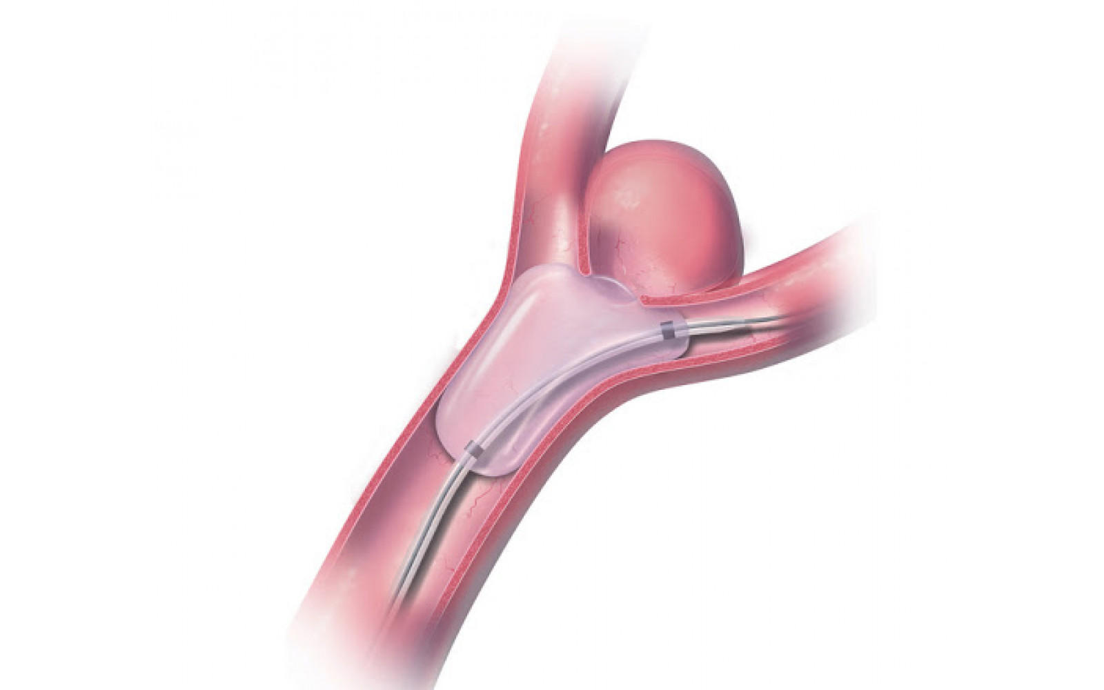 Buy HyperGlide™ and HyperForm™ balloon occlusion system